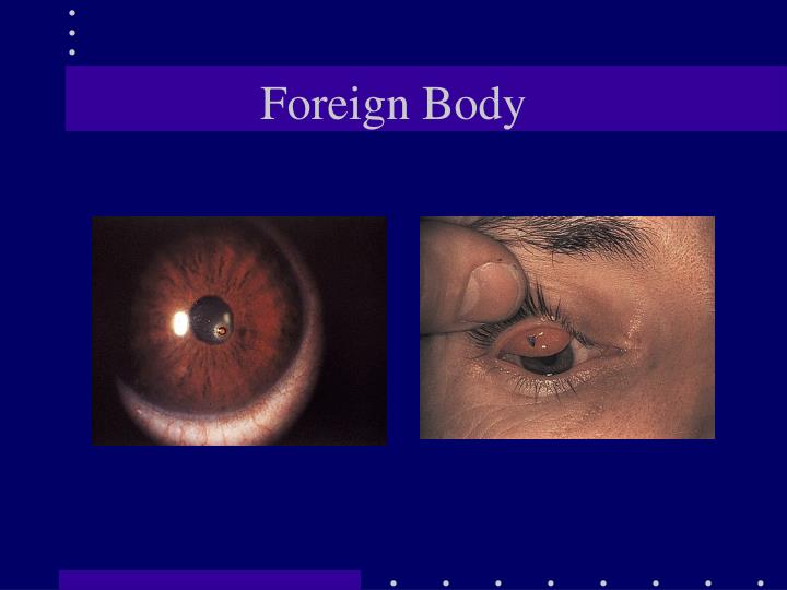 PPT - The Red Eye PowerPoint Presentation - ID:4462658