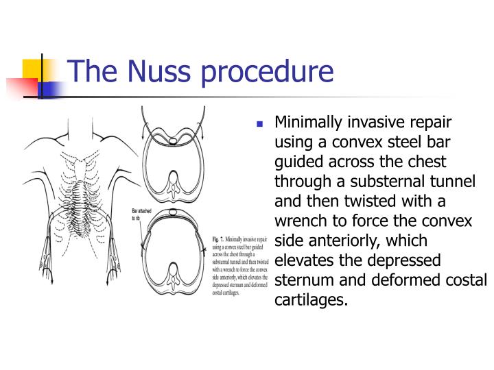 PPT - Pectus excavatum (PE) PowerPoint Presentation - ID:4473834