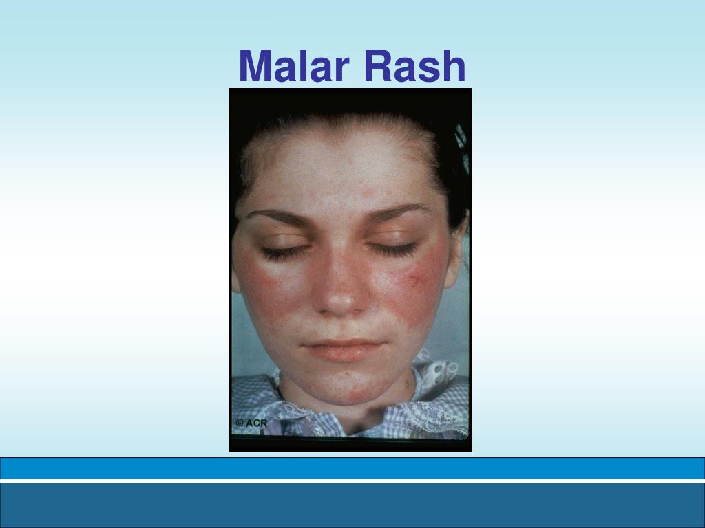 PPT - Lupus: Symptoms, Diagnosis and Treatment PowerPoint Presentation ... PPT - Lupus: Symptoms, Diagnosis and Treatment PowerPoint Presentation ...