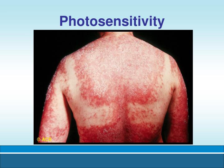 PPT - Lupus: Symptoms, Diagnosis and Treatment PowerPoint Presentation ...