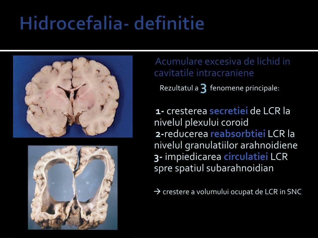 PPT - Ventriculii laterali foramen Monro ventriculul III apeductul ...
