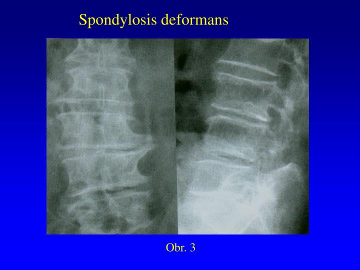 PPT - Bolesti zad PowerPoint Presentation - ID:4483278