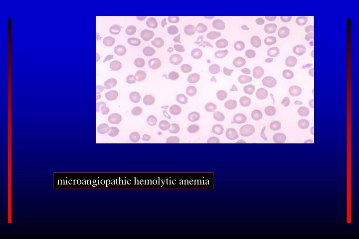 PPT - microangiopathic hemolytic anemia PowerPoint Presentation, free ...