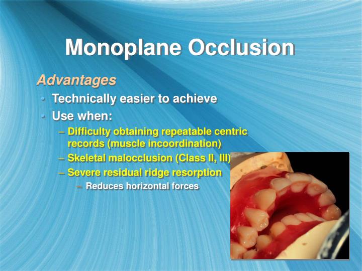 PPT - Setting Posterior Teeth PowerPoint Presentation - ID:4484665