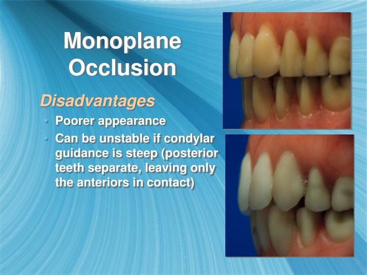 PPT - Setting Posterior Teeth PowerPoint Presentation - ID:4484665
