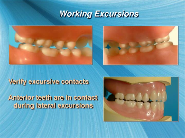 PPT - Setting Posterior Teeth PowerPoint Presentation - ID:4484665