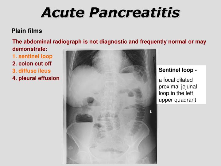 PPT - Pancreatic Diseases PowerPoint Presentation - ID:4491908