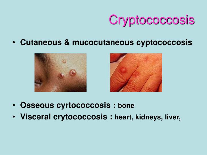 PPT - Cryptococcosis PowerPoint Presentation - ID:4493761
