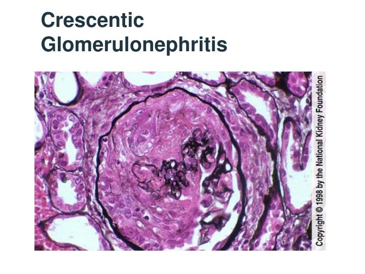 PPT - Glomerular Diseases : Nephrotic and Nephritic Syndrome PowerPoint ...
