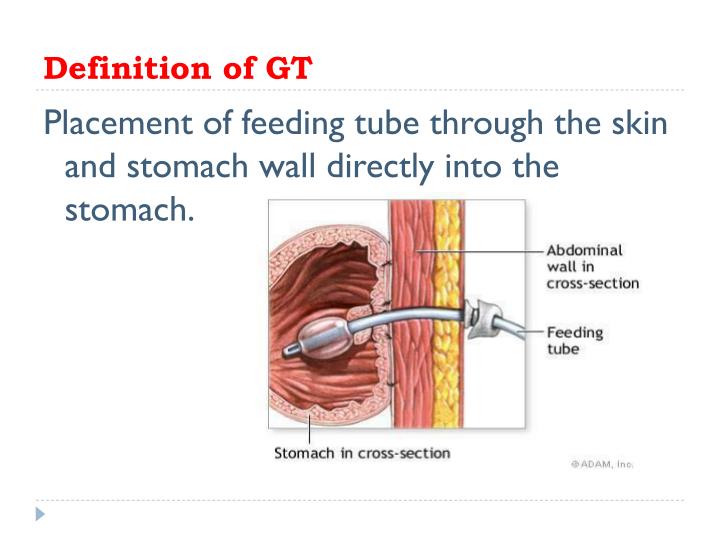 PPT - Gastrostomy Care PowerPoint Presentation - ID:4497125