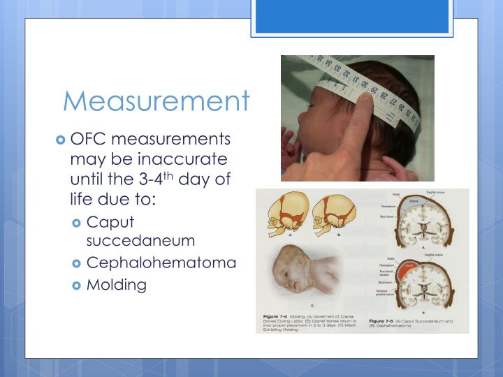 PPT - Microcephaly PowerPoint Presentation - ID:4497188