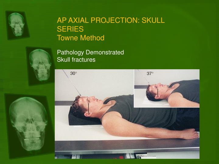 PPT - Positioning of the Skull PowerPoint Presentation - ID:4499009