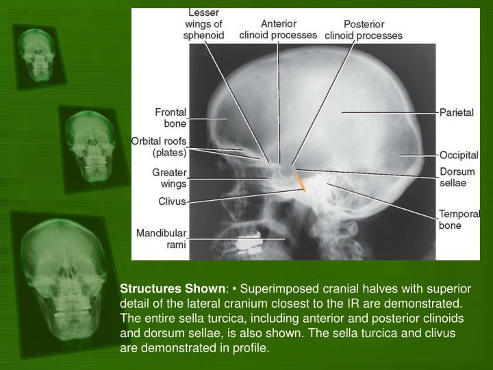 PPT - Positioning of the Skull PowerPoint Presentation - ID:4499009