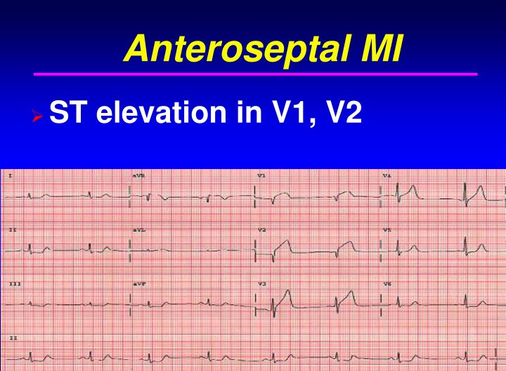 PPT - AMI/ACS Diagnosis: History and Physical PowerPoint Presentation ...