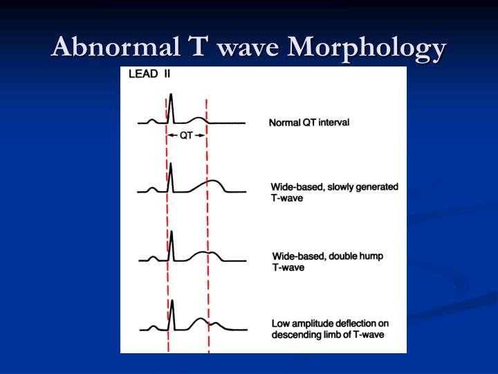 PPT - Long QT Syndrome PowerPoint Presentation - ID:4503954