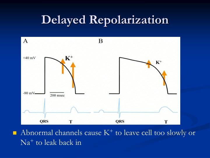 PPT - Long QT Syndrome PowerPoint Presentation - ID:4503954