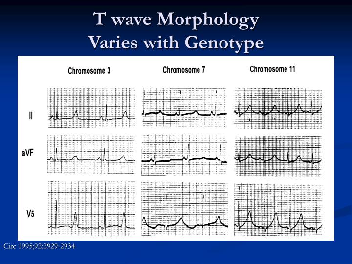 PPT - Long QT Syndrome PowerPoint Presentation - ID:4503954