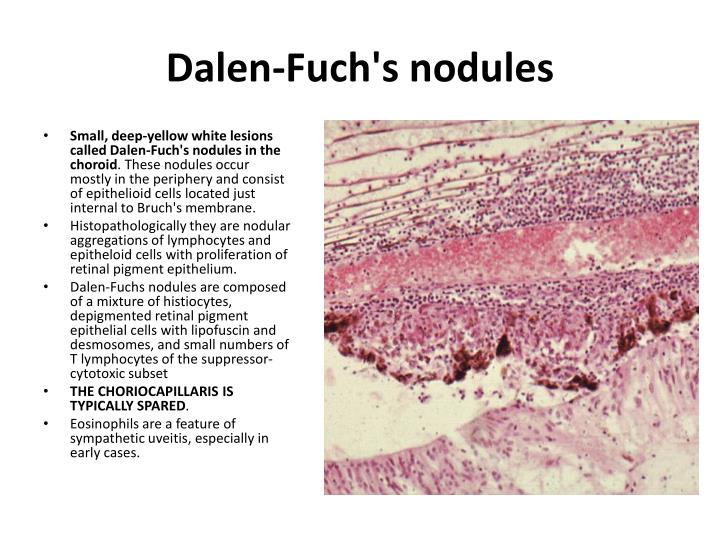 PPT - SYMPATHETIC OPHTHALMIA PowerPoint Presentation - ID:4504446