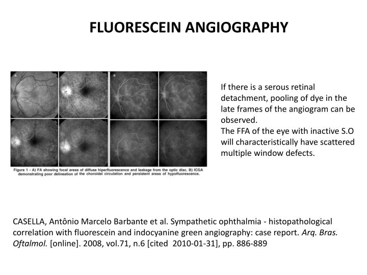 PPT - SYMPATHETIC OPHTHALMIA PowerPoint Presentation - ID:4504446