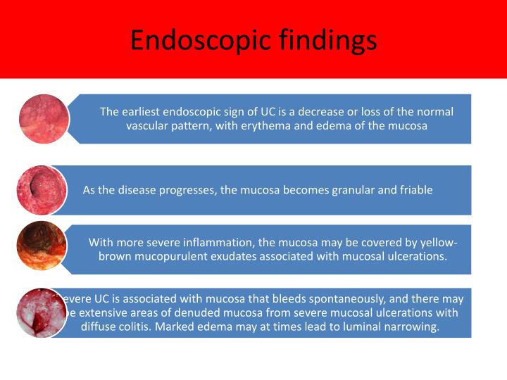 PPT - Ulcerative colitis PowerPoint Presentation - ID:4505529
