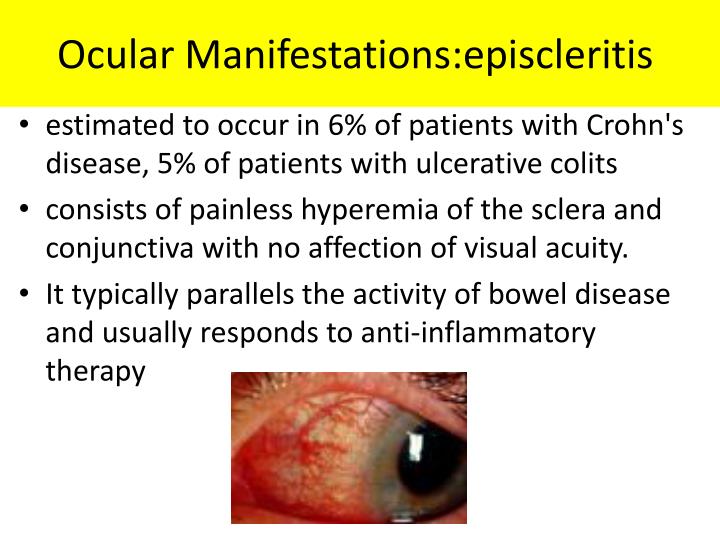 PPT - Ulcerative colitis PowerPoint Presentation - ID:4505529