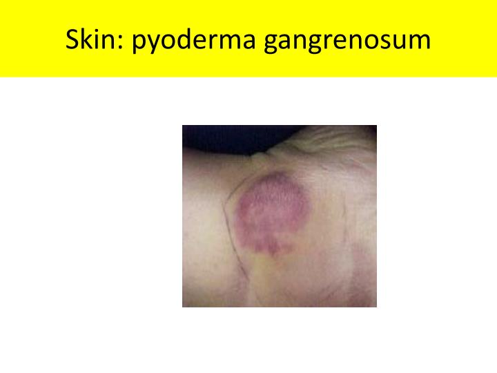 PPT - Ulcerative colitis PowerPoint Presentation - ID:4505529