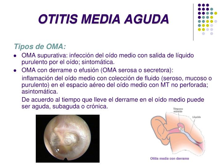 Otitis Media Aguda