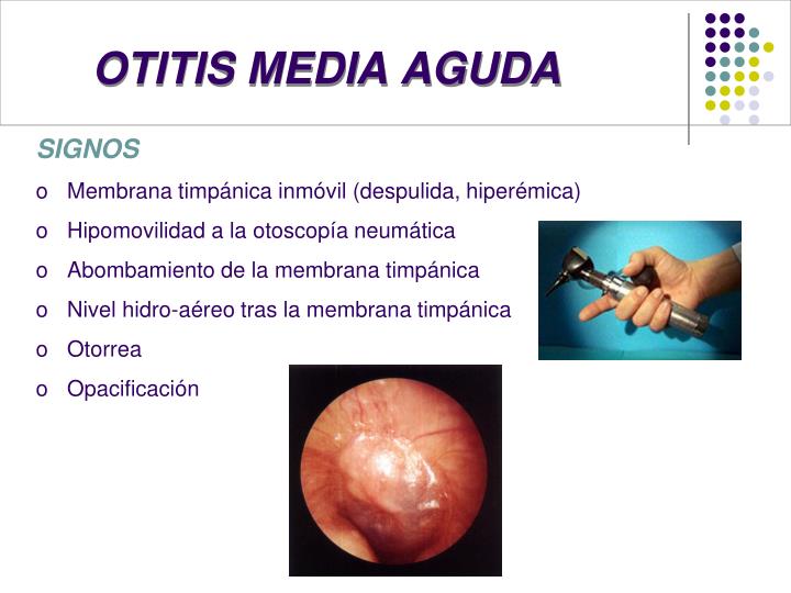PPT - OTITIS PowerPoint Presentation - ID:4511398