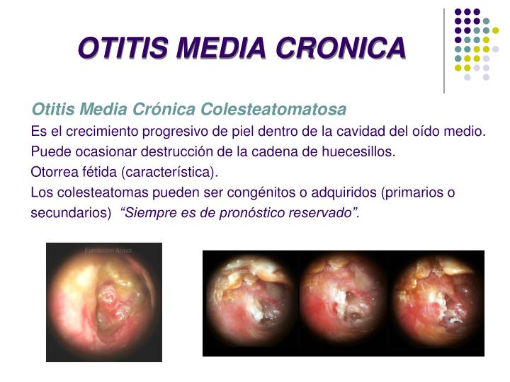 PPT - OTITIS PowerPoint Presentation - ID:4511398