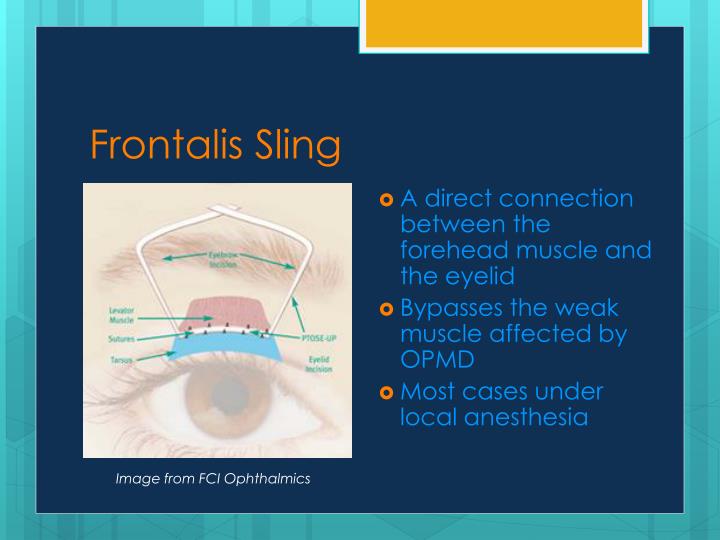PPT - Management of Ptosis in OPMD PowerPoint Presentation - ID:4512824