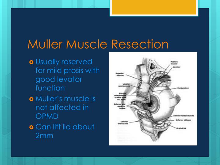 PPT - Management of Ptosis in OPMD PowerPoint Presentation - ID:4512824