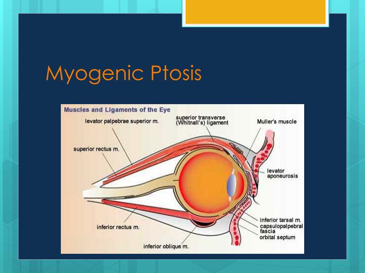PPT - Management of Ptosis in OPMD PowerPoint Presentation - ID:4512824