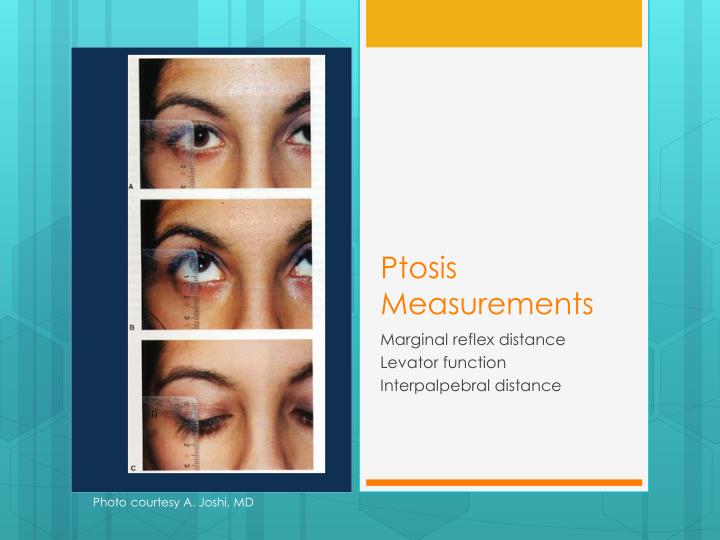 PPT - Management of Ptosis in OPMD PowerPoint Presentation - ID:4512824
