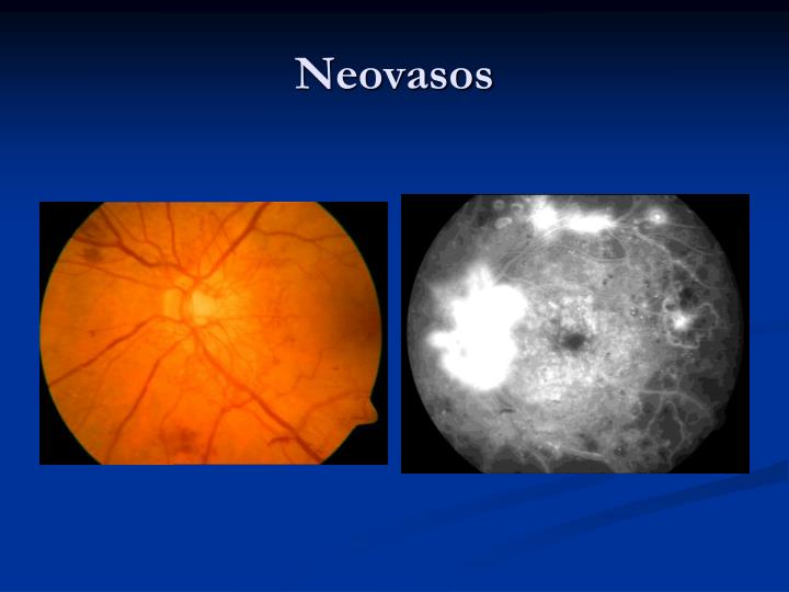 PPT - Fundo de olho normal e patológico PowerPoint Presentation - ID ...