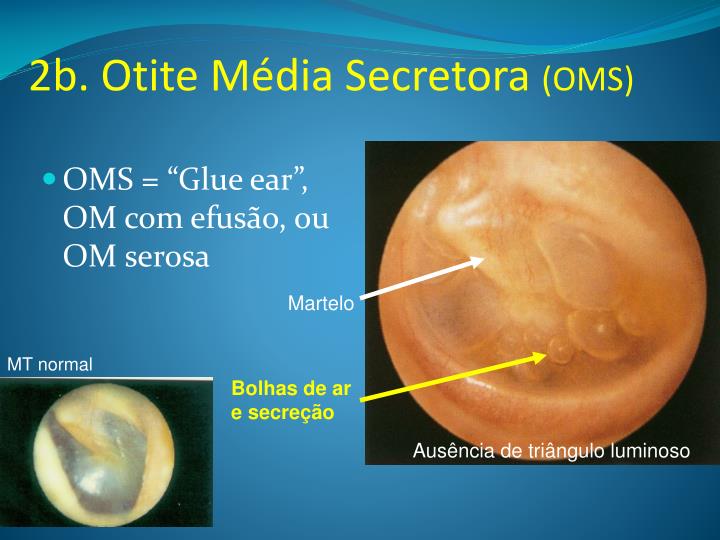 PPT - OTITES 1. Otite Externa 2. Otite Média PowerPoint Presentation ...