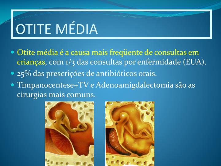 PPT - OTITES 1. Otite Externa 2. Otite Média PowerPoint Presentation ...