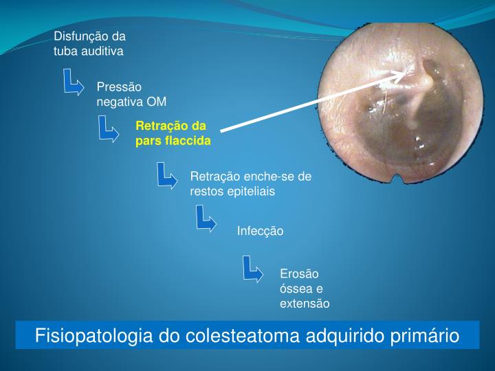 PPT - OTITES 1. Otite Externa 2. Otite Média PowerPoint Presentation ...