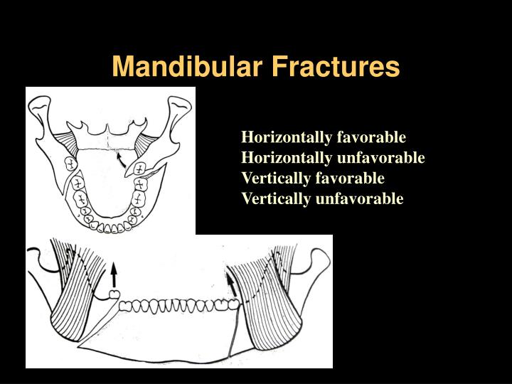 PPT - Treatment principles of maxillofacial trauma PowerPoint ...