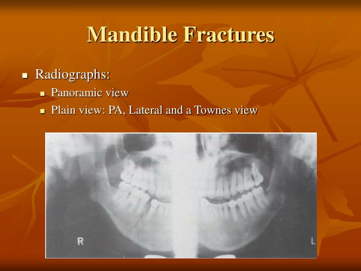 PPT - Maxillofacial trauma PowerPoint Presentation - ID:4518457
