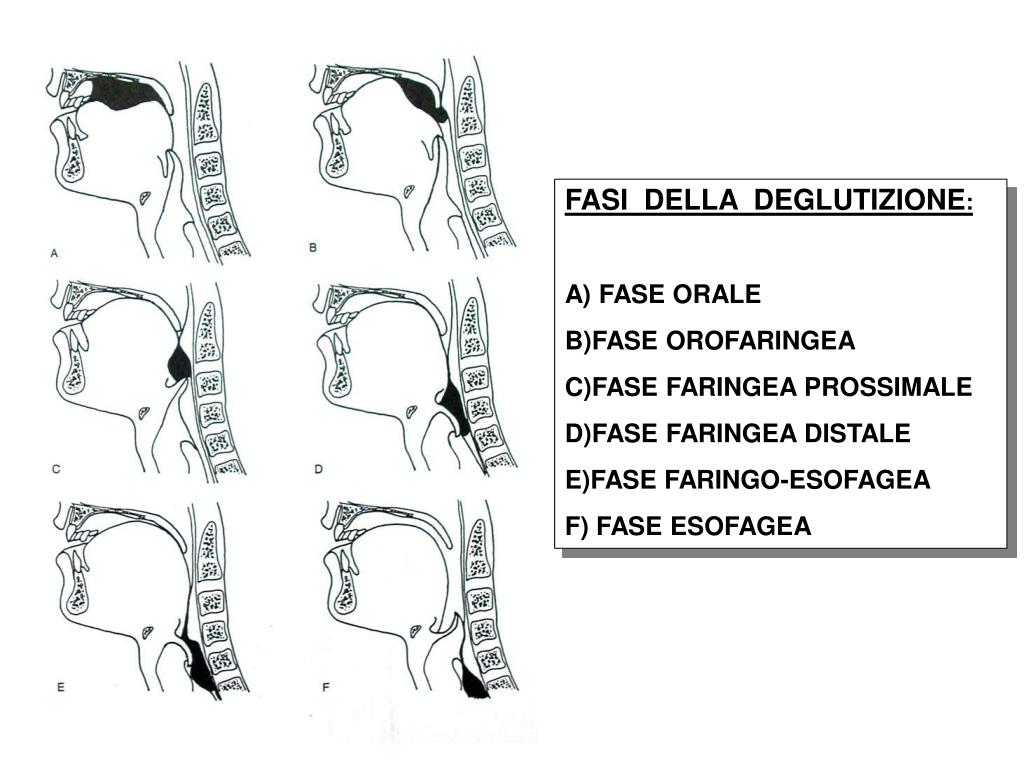 PPT - COS’E’ LA DISFAGIA VALUTAZIONE GESTIONE TRATTAMENTO PowerPoint ...