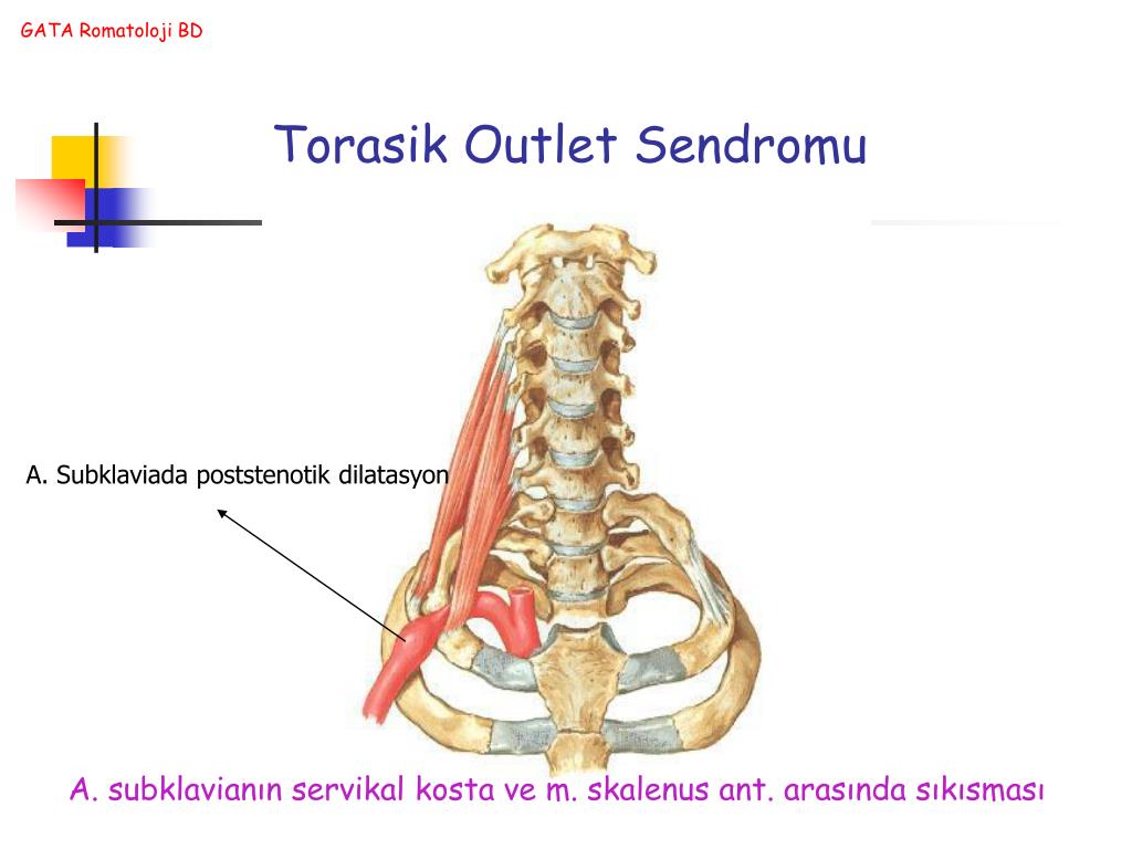 PPT - Omuz Bölgesine Yansıyan Radiküler ve Viseral Ağrılar PowerPoint ...