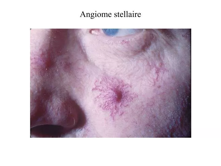 PPT - Angiome stellaire PowerPoint Presentation, free download - ID:4528932