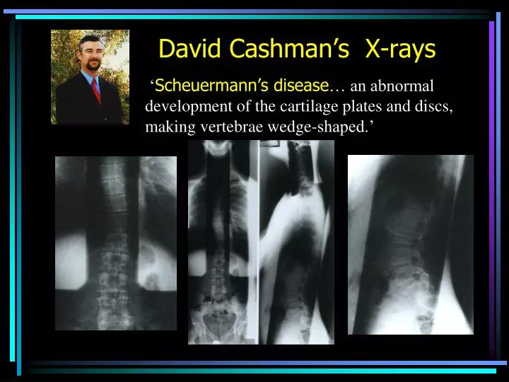 PPT - David Cashman’s X-rays PowerPoint Presentation, free download ...