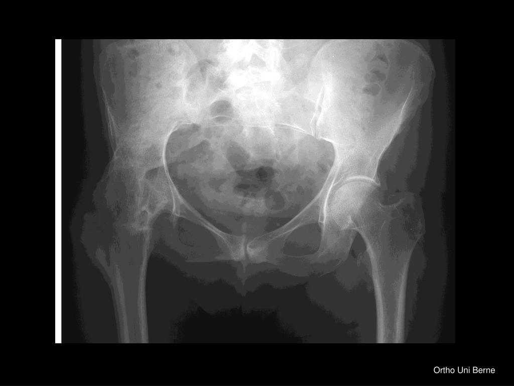 PPT - Extreme ectasia of the femoral diaphysis secondary to loosening ...