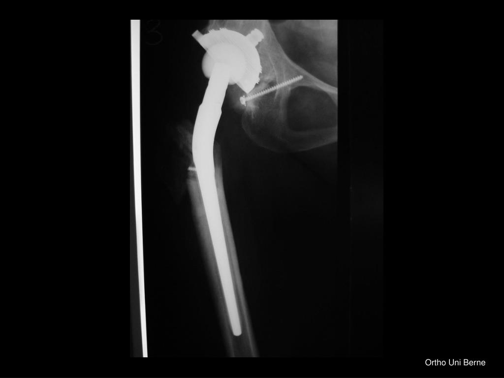 PPT - Extreme ectasia of the femoral diaphysis secondary to loosening ...