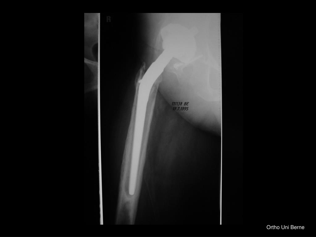 PPT - Extreme ectasia of the femoral diaphysis secondary to loosening ...