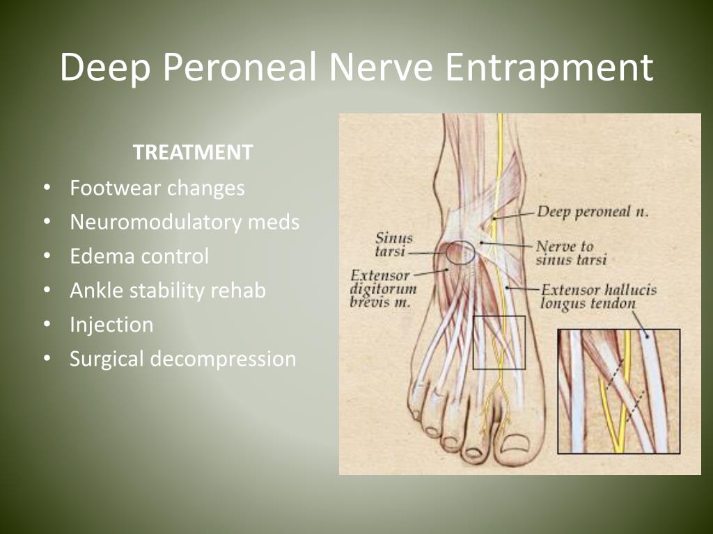 Peroneal Nerve Entrapment Treatment