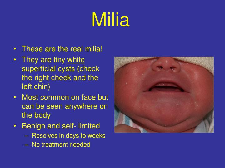 PPT - Common Rashes in the Newborn PowerPoint Presentation - ID:4540089