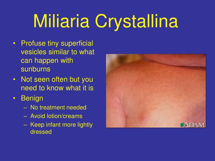PPT - Common Rashes in the Newborn PowerPoint Presentation - ID:4540089