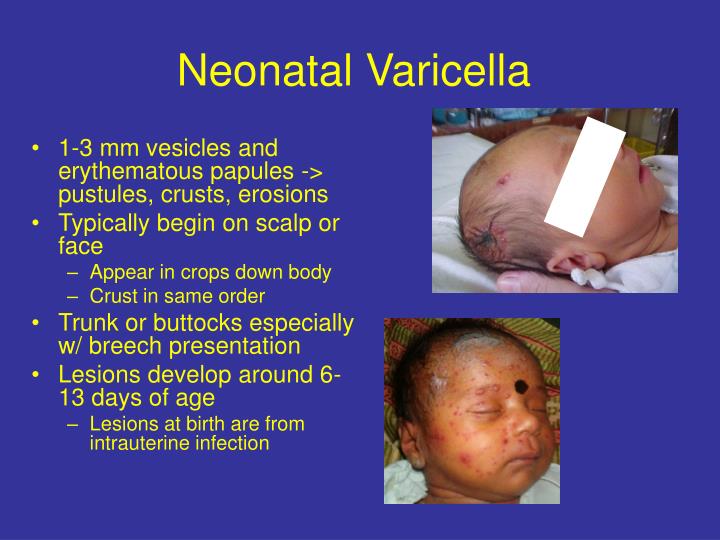 PPT - Common Rashes in the Newborn PowerPoint Presentation - ID:4540089